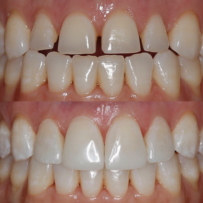 Digitally Assisted Anterior Composite Restorations